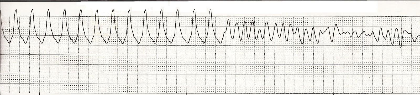 What Are The Shockable Rhythms (and Why)?