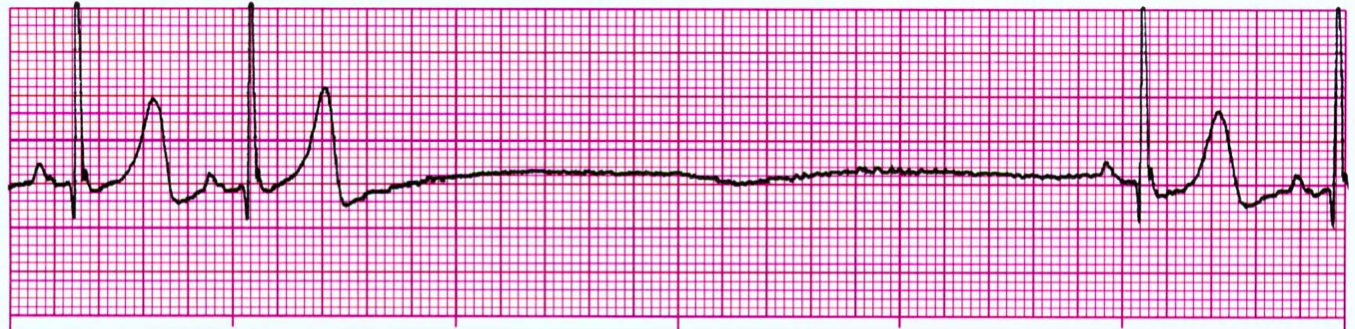 ACLS Cardiac Arrhythmia Quiz #8