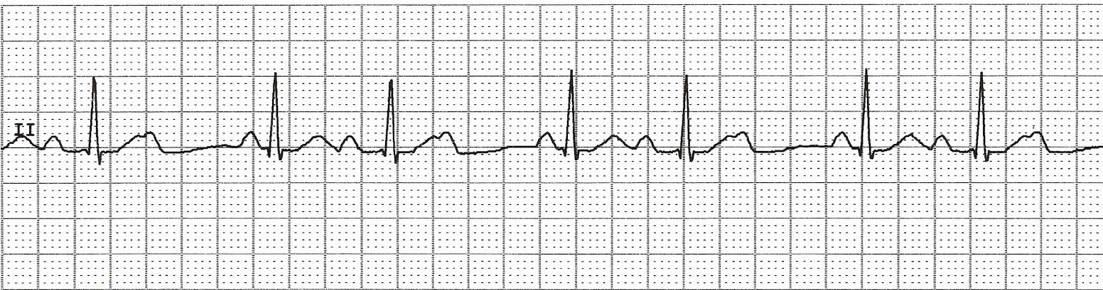 ACLS Cardiac Arrhythmia Quiz #5