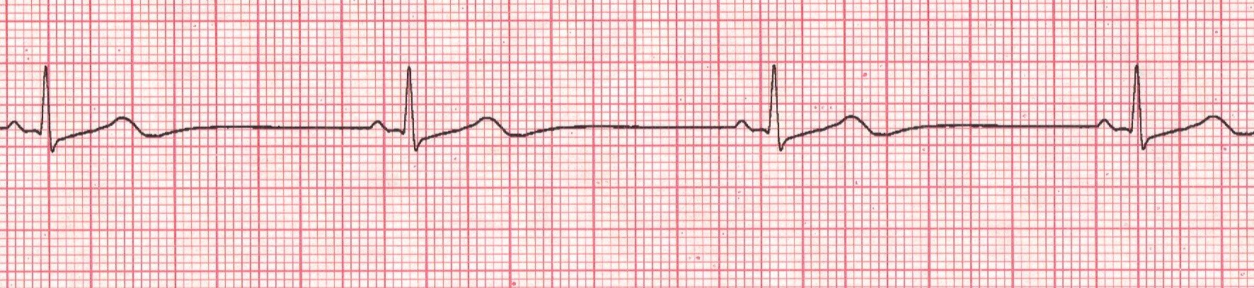 ACLS Cardiac Arrhythmia Quiz #4 - Which condition does this ECG tracing ...