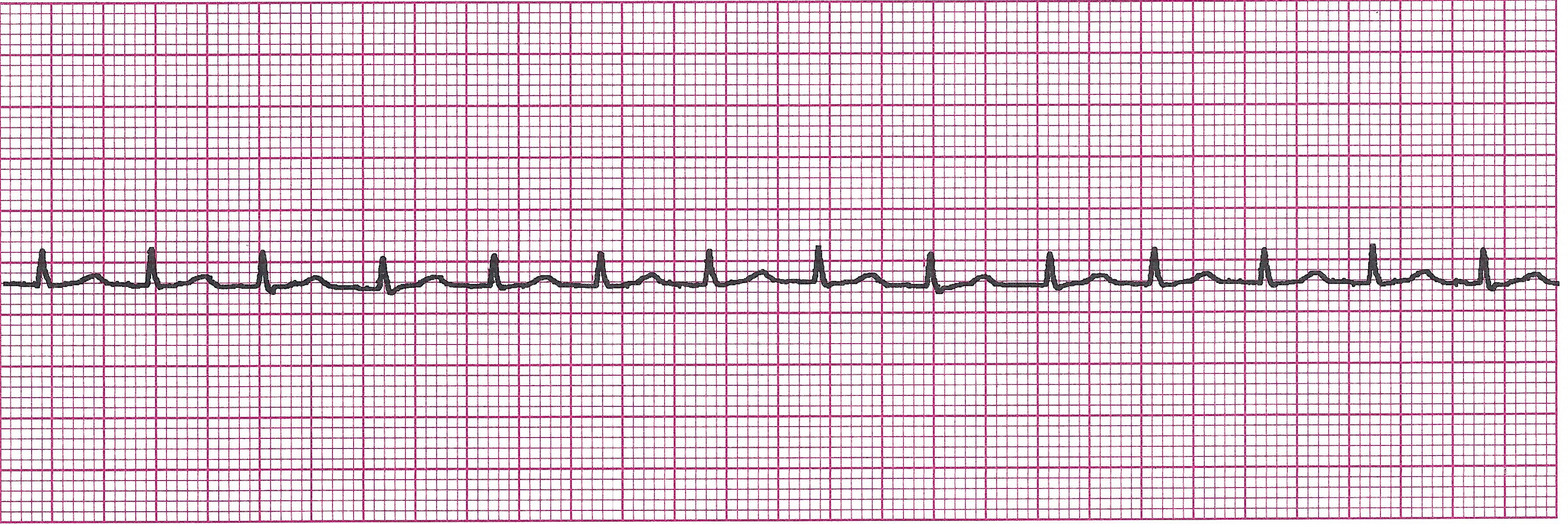 ACLS Cardiac Arrhythmia Quiz #6