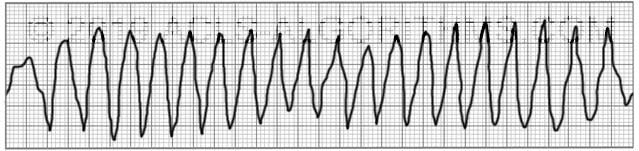 What Are The Shockable Rhythms (and Why)?